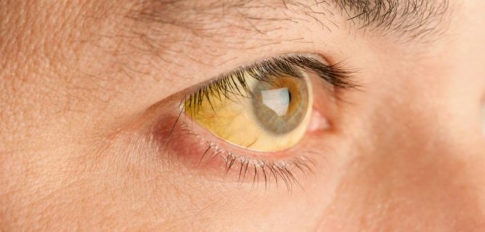 Ictericia: causas, síntomas y tratamiento - Meditip