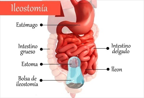 Ileostomía ¿Qué es una ileostomía? - Todo lo que debes saber - Meditip