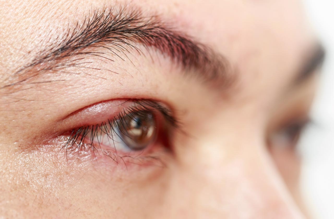 Causas de orzuelo: tipos y factores de riesgo - Meditip