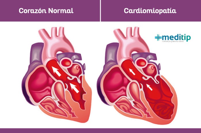 La enfermedad cardiaca en imágenes - Meditip