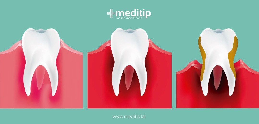 Periodontitis o la enfermedad periodontal - Meditip