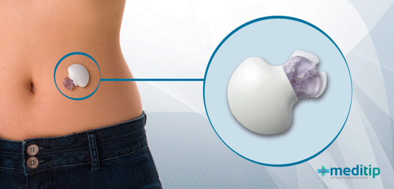 La diabetes y el monitoreo continuo de glucosa - Meditip