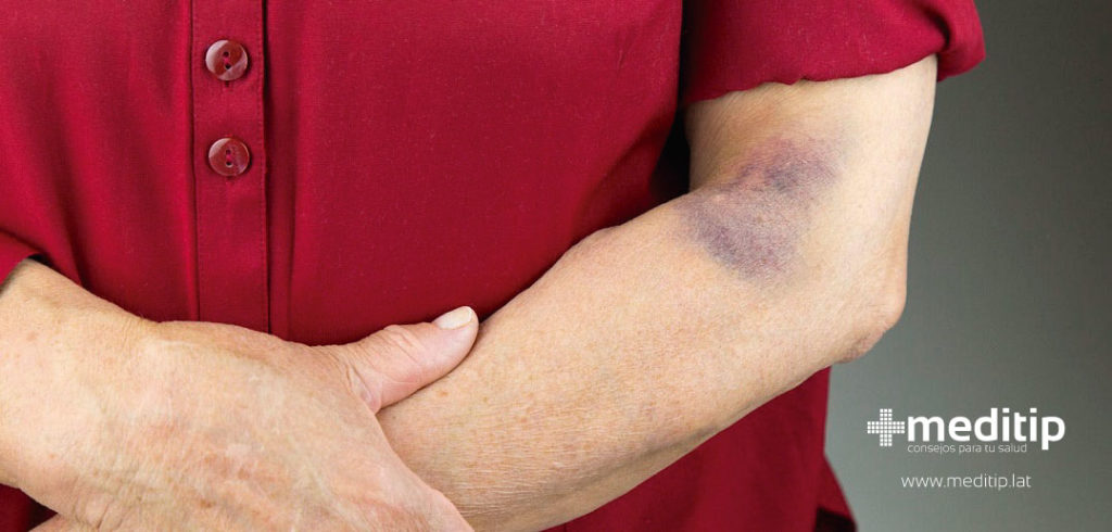 ¿Cómo tratar los moretones desde el hogar? - Meditip
