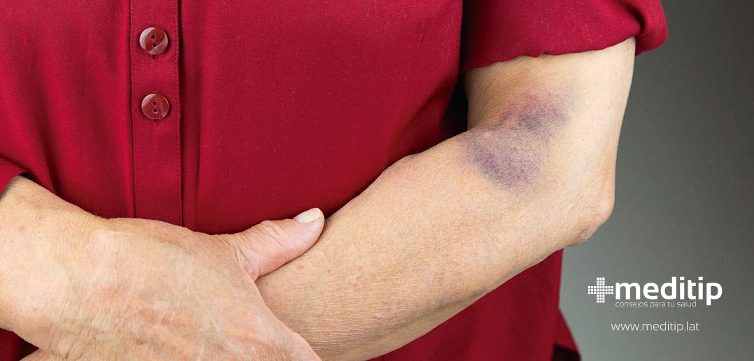 ¿Cómo tratar los moretones desde el hogar? - Meditip