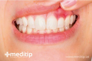Gingivitis: causas, tratamiento y prevención - Meditip