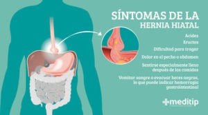 hernia-hiatal-tipos-causas-s-ntomas-y-tratamiento
