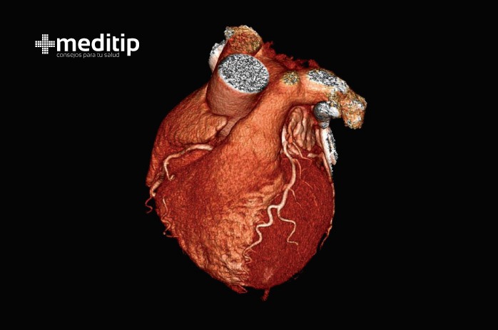 La enfermedad cardiaca en imágenes - Meditip