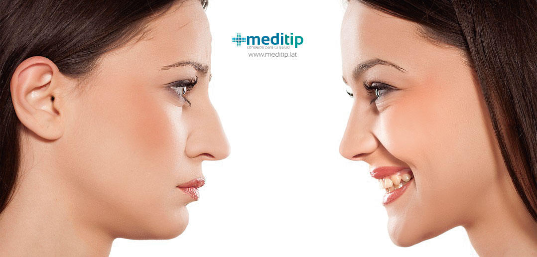 Operación de nariz: 12 factores a considerar - Meditip