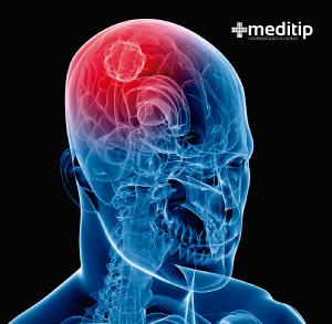 Alucinaciones: definición, diagnóstico y tratamiento - Meditip