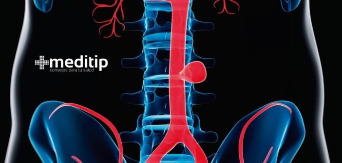 Aneurisma: tipos, causas y tratamiento - Meditip