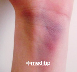 Qué es una herida: definición y tratamiento - Meditip