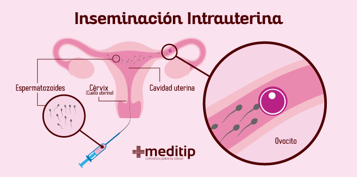 Infertilidad: causas, diagnóstico y tratamiento - Meditip