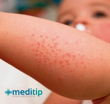 Dermatitis: tipos, causas y complicaciones - Meditip