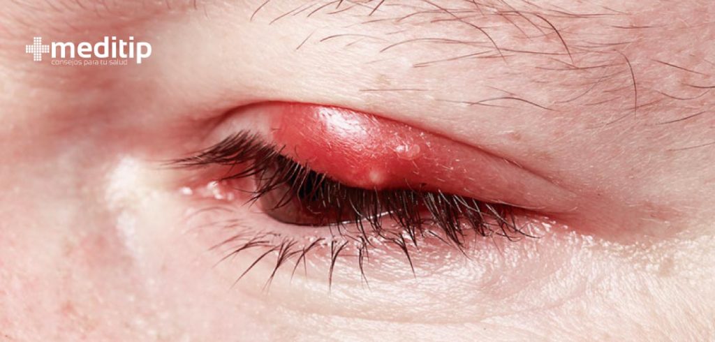 Inflamación: causas, síntomas y tratamiento - Meditip