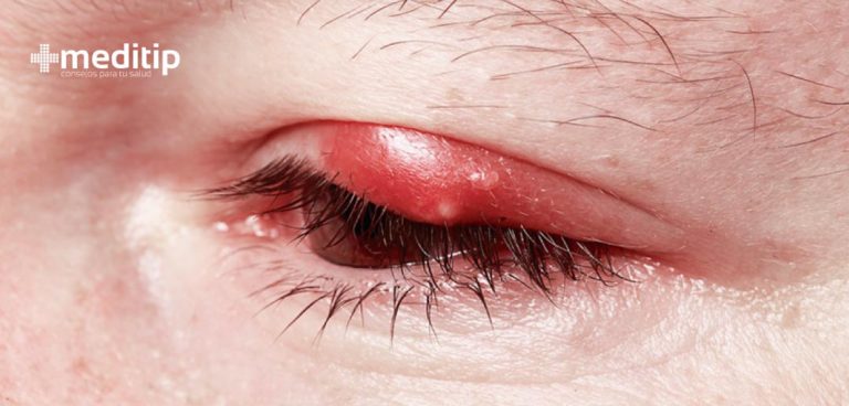 Inflamación: causas, síntomas y tratamiento - Meditip