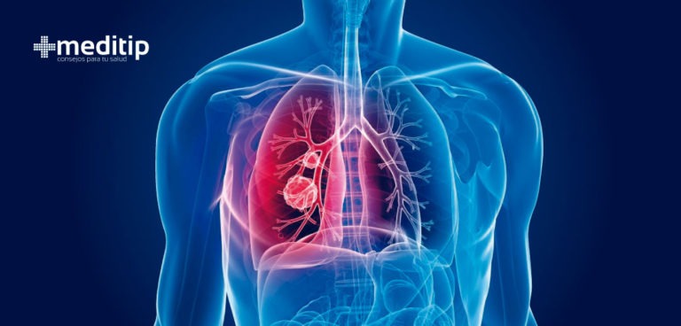 Tuberculosis y todo lo que debes saber sobre su diagnóstico y tratamiento