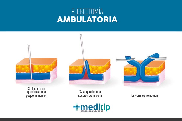 Várices o venas varicosas: causas, síntomas y tratamiento (remedios ...