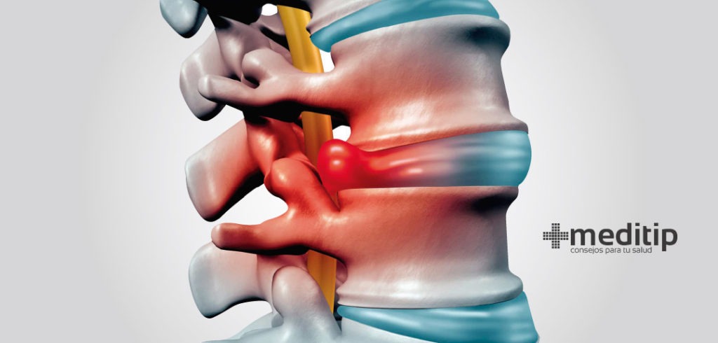 Hernia de disco: definición, diagnóstico y tratamiento - Meditip
