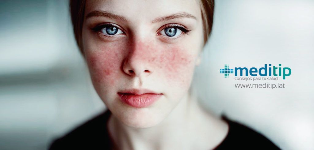 Lupus: causas, diagnóstico y tratamiento - Qué es y cómo se trata
