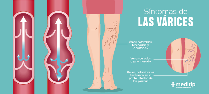Várices o venas varicosas: causas, síntomas y tratamiento (remedios ...