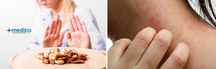 Alergia: causas, diagnóstico y tratamiento - Meditip
