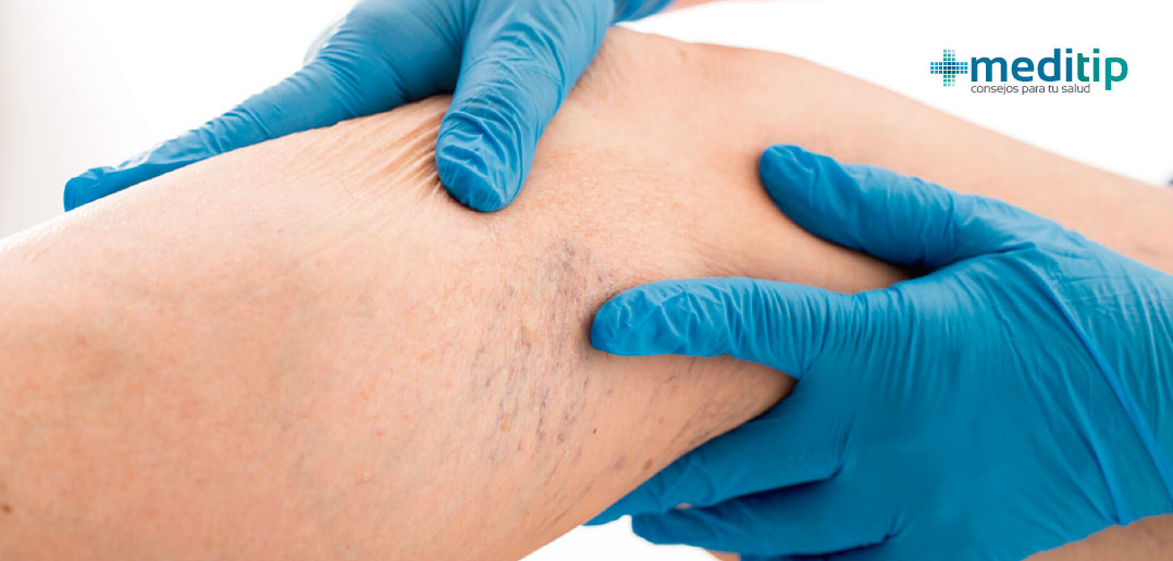 Várices o venas varicosas: causas, síntomas y tratamiento (remedios ...