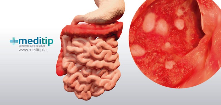 Colitis ulcerosa: causas, diagnóstico y tratamiento - Meditip