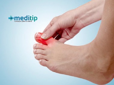 Gota y ácido úrico: definición, causas y tratamiento