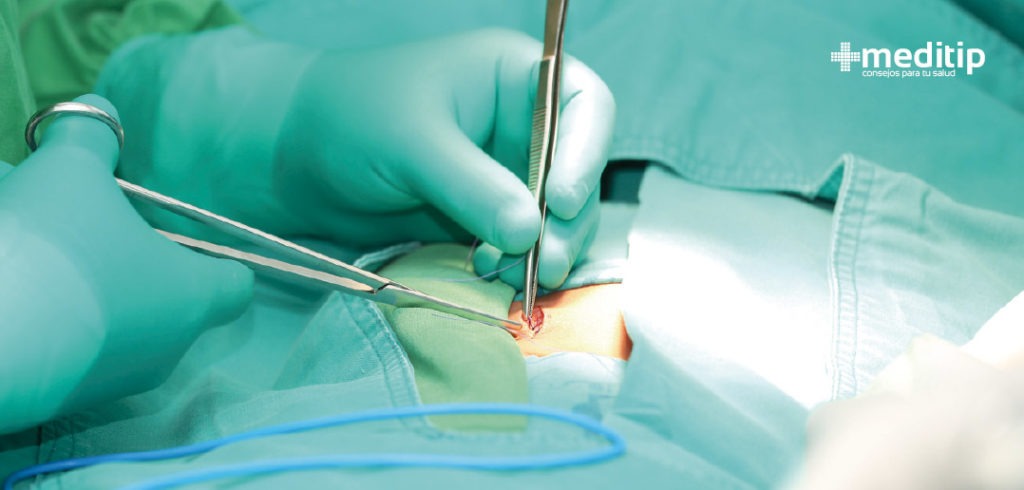Herida quirúrgica: tipos, causas y tratamiento - Meditip