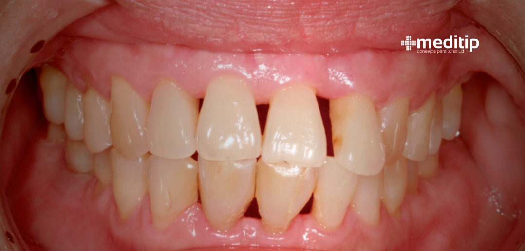 Recesión gingival (encías retraídas): causas, diagnóstico y tratamiento