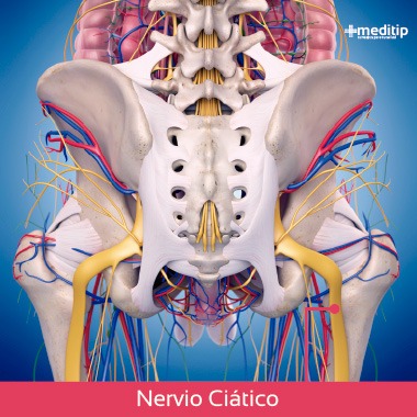 Ciática o dolor de ciática: causas, síntomas y tratamiento - Meditip