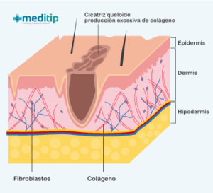 Qué es una cicatriz: proceso de formación, tipos y tratamiento - Meditip