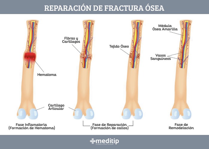 Fracturas: biología de la curación, reparación celular y tratamiento