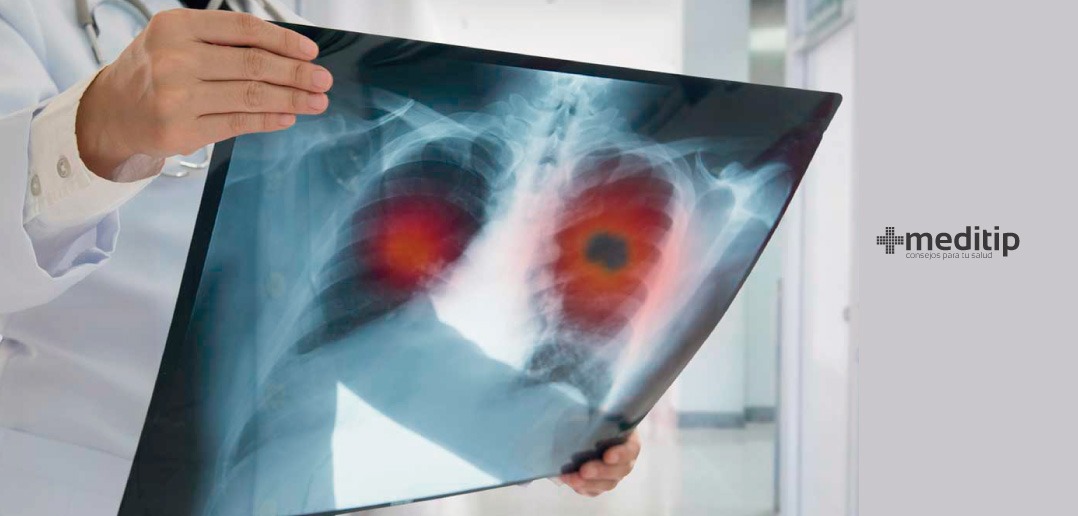 Primeros síntomas de cáncer y el diagnóstico oportuno - Meditip