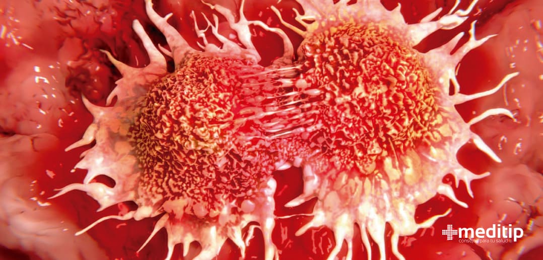 Cómo se extiende el cáncer y qué es la metástasis - Meditip