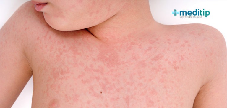 Primeros síntomas del sarampión: la clave para el tratamiento exitoso