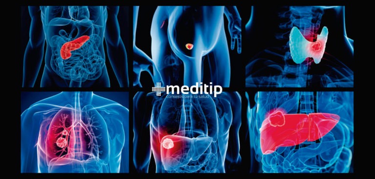 Tipos de cáncer y su desarrollo en el cuerpo - Meditip, el portal de la ...