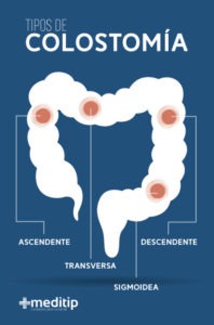 Colostomía ¿Qué es una colostomía? | Tipos de colostomías