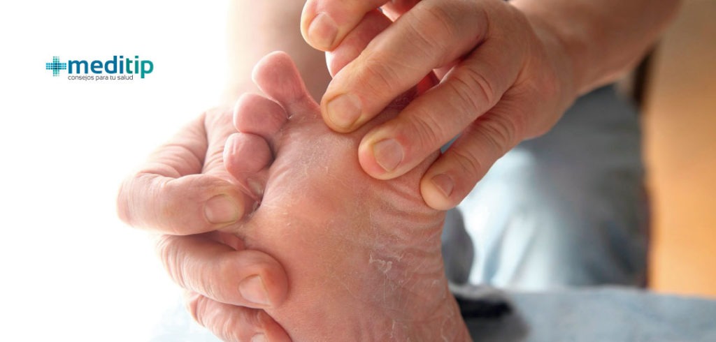 Causas del pie de atleta: contagio y tratamiento - Meditip