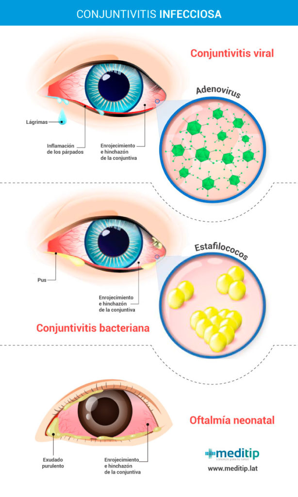 Tratamiento de la conjuntivitis: identifica los síntomas que requieren ...