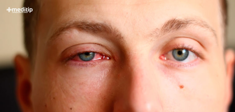 Causas de los ojos rojos e irritados - Meditip