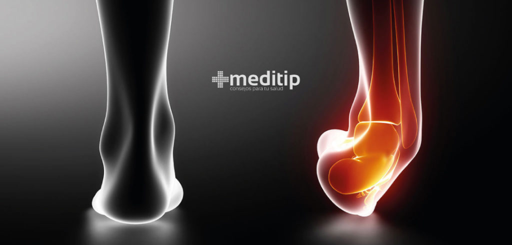 Tratamiento de un esguince: tobillo, rodilla, muñeca y dedo - Meditip