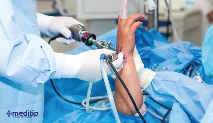 Beneficios de la artroscopia: qué es y en qué consiste una artroscopia