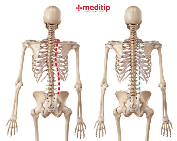 Desviación de la columna, qué es normal y qué es escoliosis - Meditip