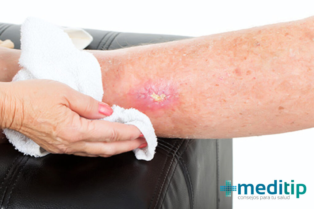 Herida infectada - infección en una herida