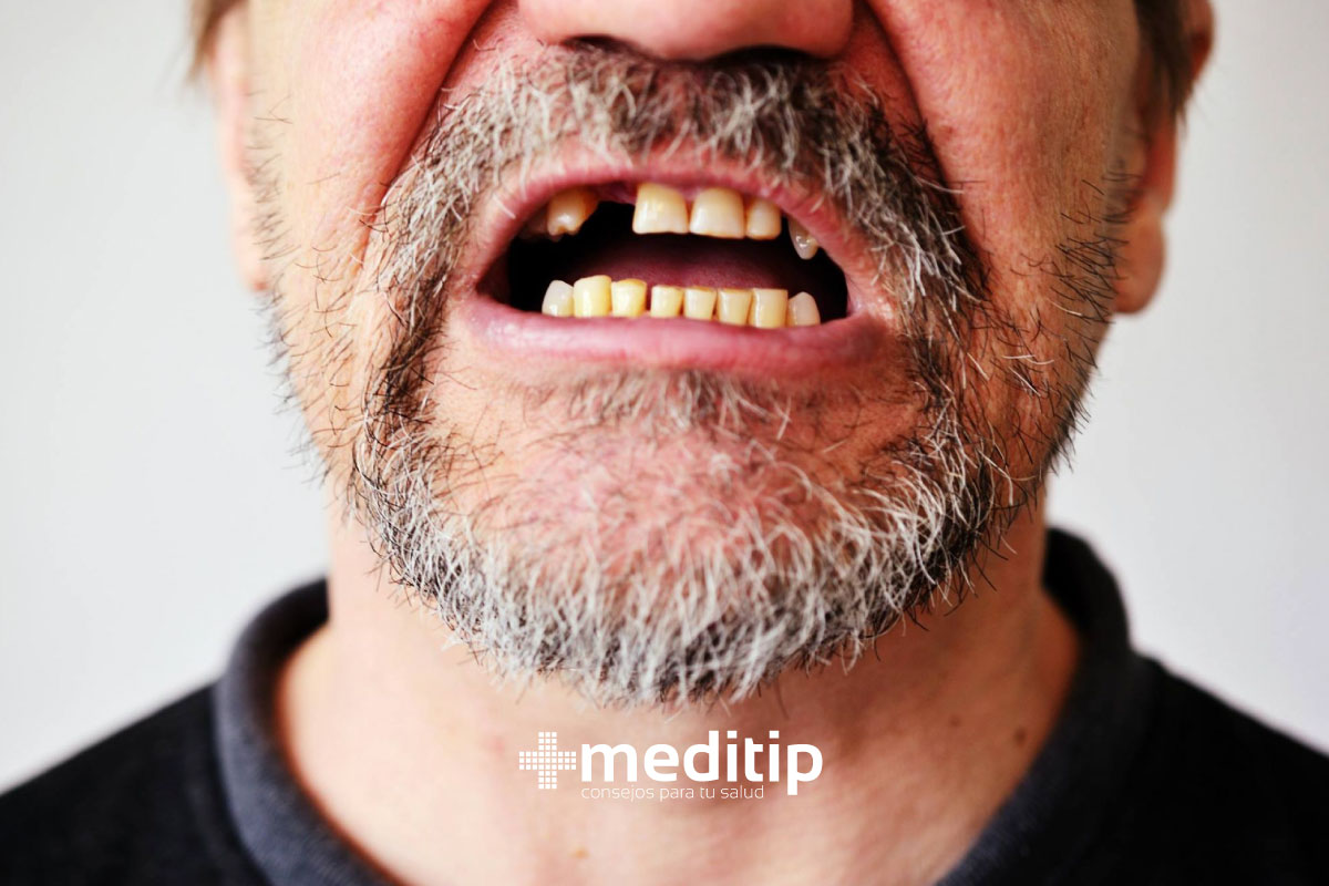 Consecuencias de la pérdida de dientes - Meditip