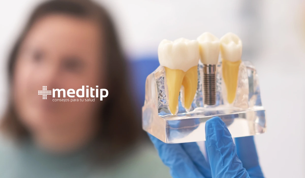 Beneficios Estéticos y Funcionales de los Implantes Dentales - Meditip